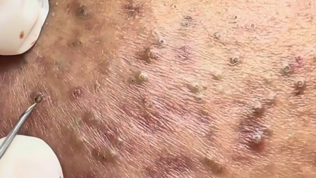 Satisfying Acne and Pimple Removal Blackheads & Whiteheads #1170 - YouTube