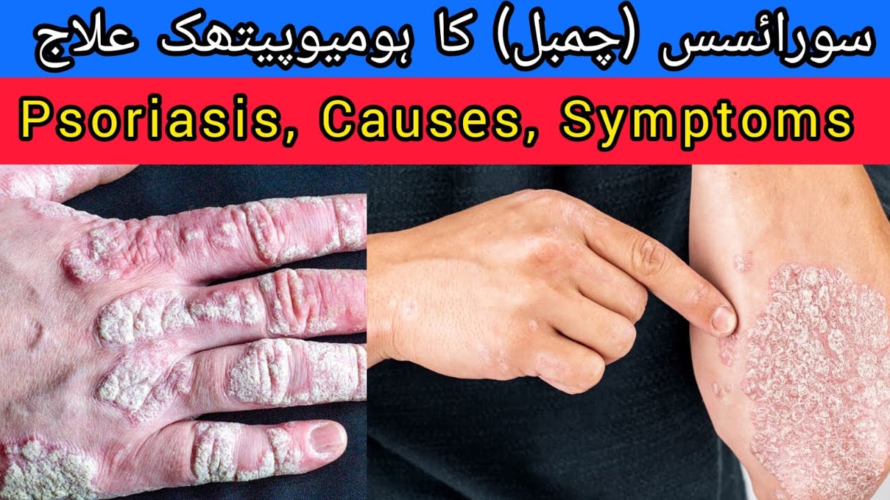 Psoriasis | Kharish | Chambal Ka Ilaj | Homeopathic medicine - YouTube