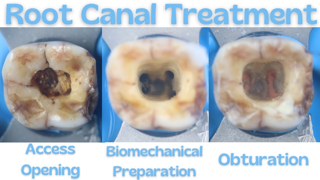 Root Canal Treatment🔵Mandibular 2nd Molar🟡Access Opening🟢 Biomechanical ...