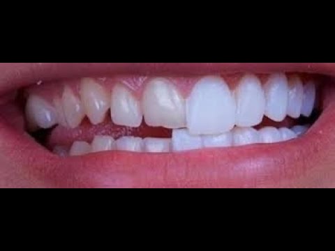 Ön diş çürük,estetik dolgu,öndiş dolgu(1dakikadadiş)