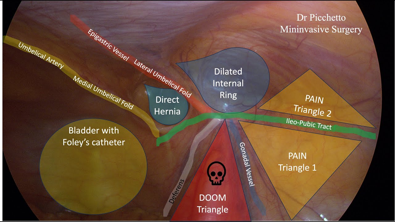 TAPP with Artisential Articulated Laparoscopic Instruments - YouTube