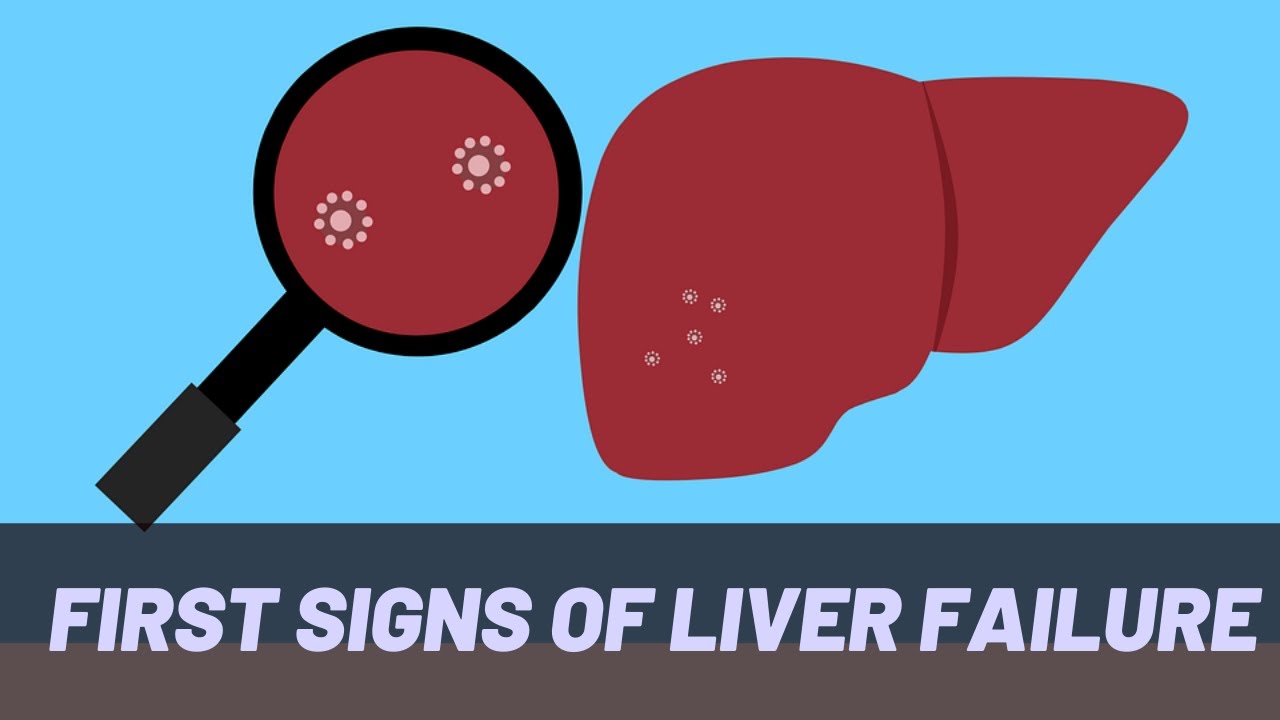 First Signs of Liver Failure - YouTube