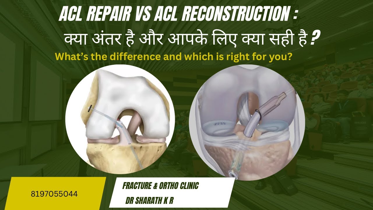 ACL REPAIR vs ACL RECONSTRUCTION: What’s the difference and which is ...