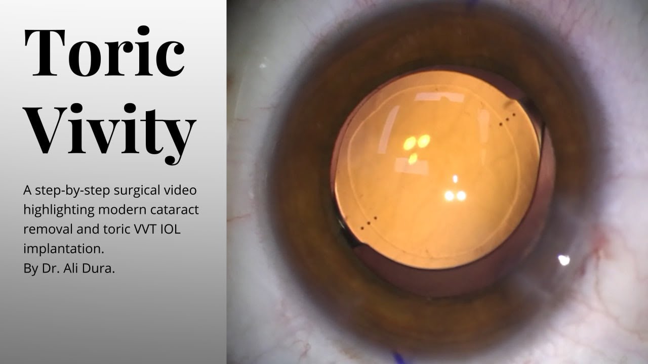 Cataract Surgery with Toric Vivity IOL | Dr. Ali Dura - YouTube