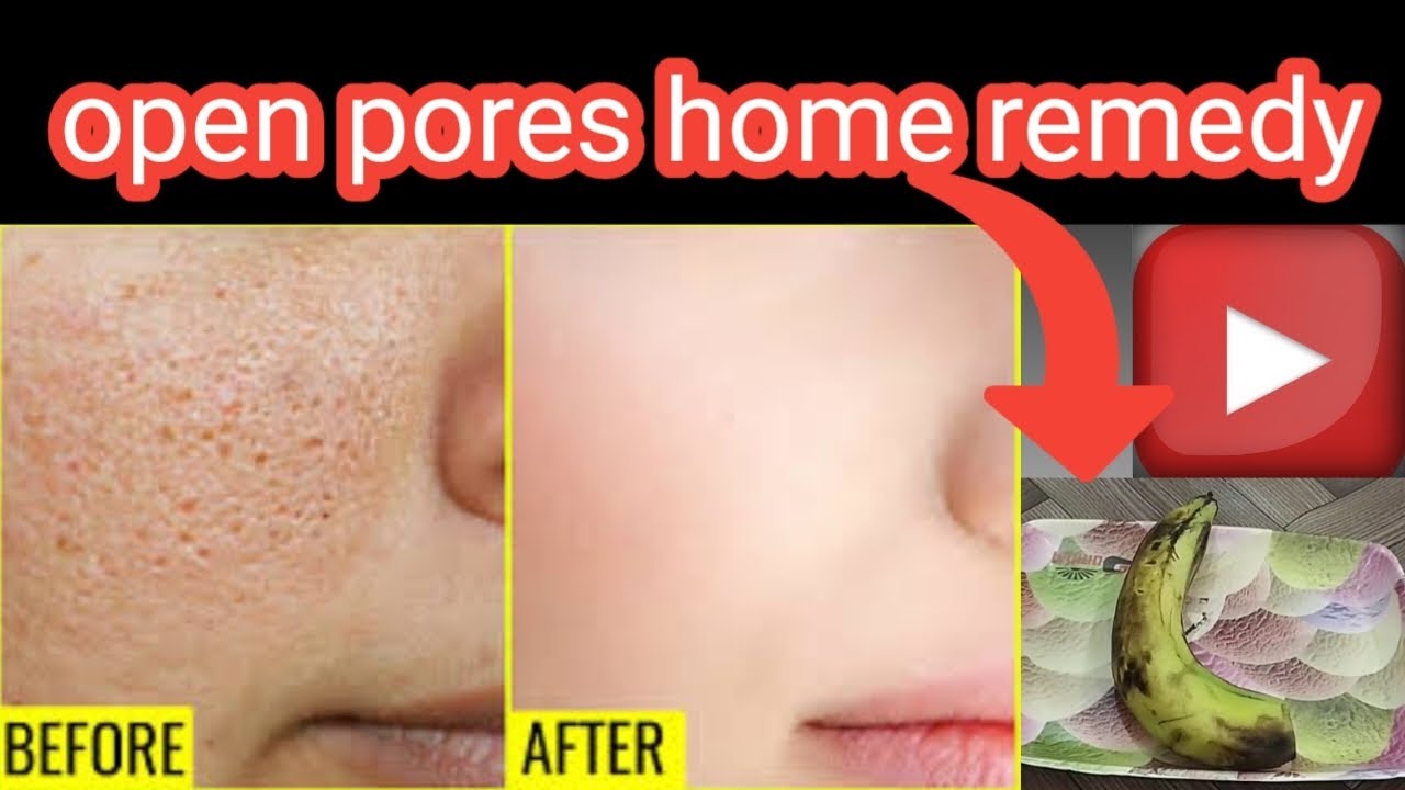 open pores home remedy| how to shrink open pores on face #skincare # ...