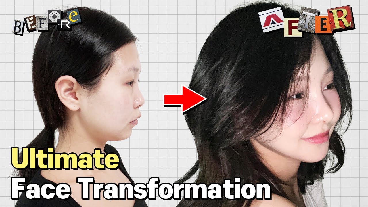 Ultimate Face Transformation VLOG | FACIAL CONTOURING, RHINOPLASTY ...