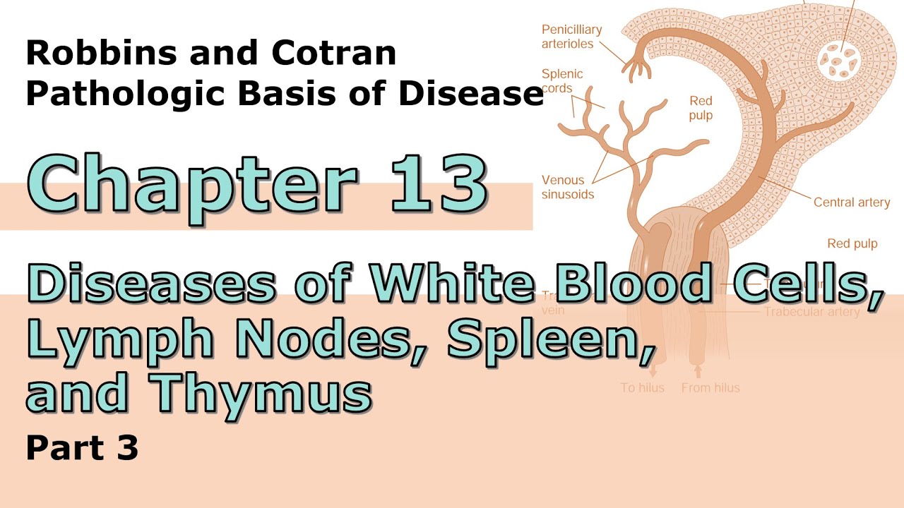 【Robbins病理學】Chapter 13 Diseases of White Blood Cells, Lymph Nodes ...