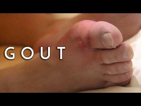 Relief from Gout Pain - Principal Podiatrist Michael Lai, East Coast Podiatry