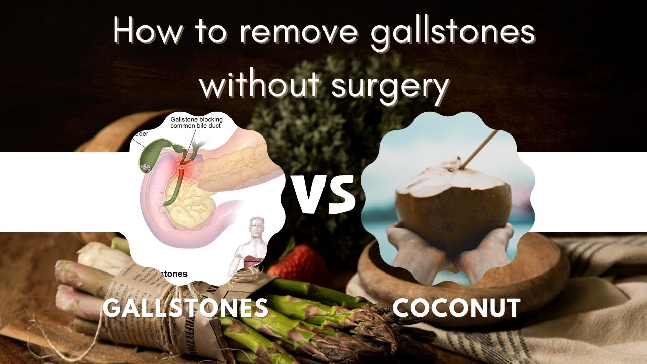 How To Remove Gallstones Without Surgery Youtube Clever Health - YouTube