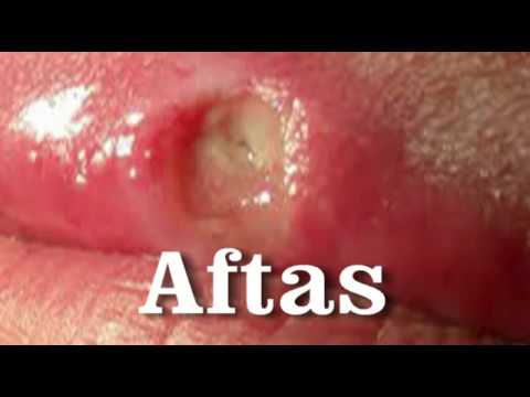 Aftas soluções caseiras para aliviar as dores. - YouTube