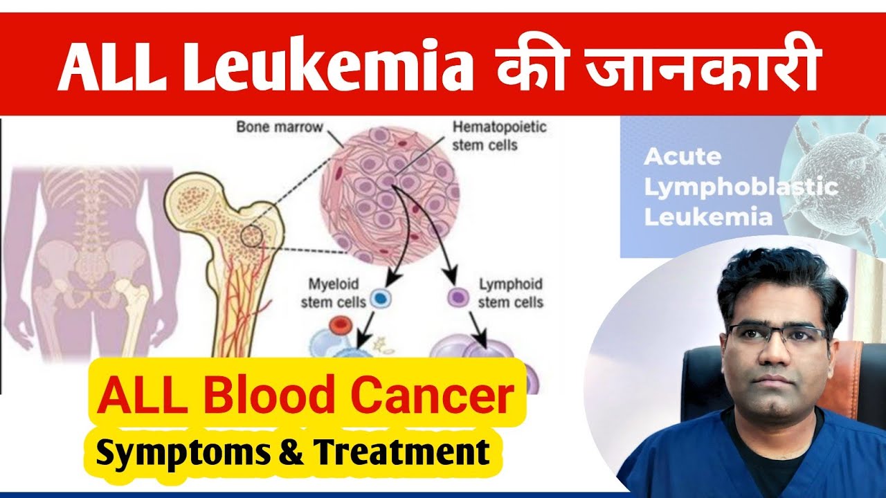 ALL Leukemia Symptoms and Treatment Explained | (Acute Lymphoid leukemia) | ब्लड कैंसर - YouTube