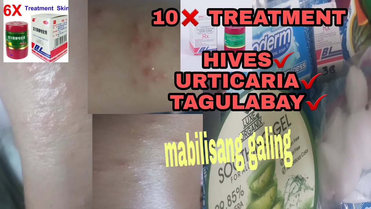 HOW TO CURE URTICARIA KATI SA KATAWAN 10X EFFECTIVE |DIANALYN RUAR ...