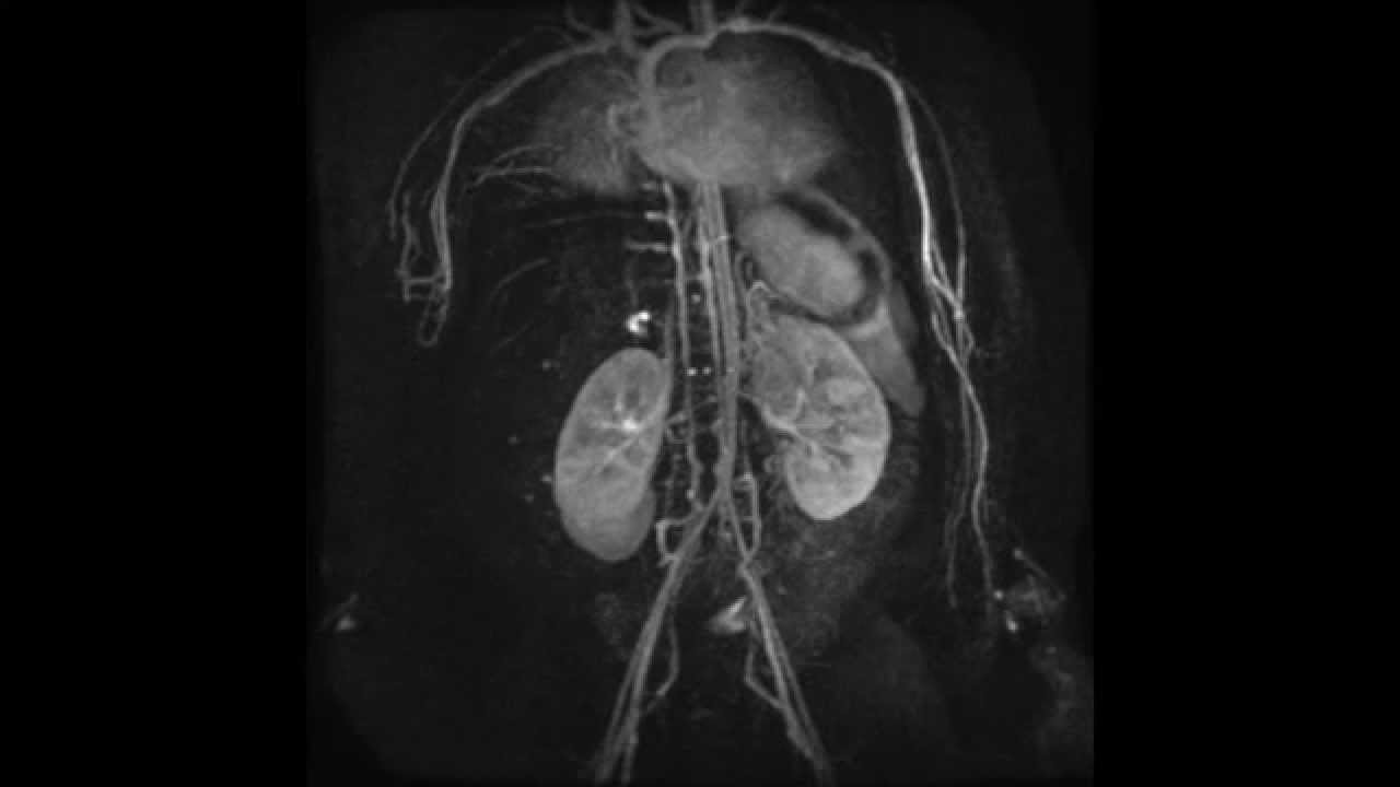 Time resolved (TRICKS) enhanced high resolution MRA at 1.5 T. - YouTube