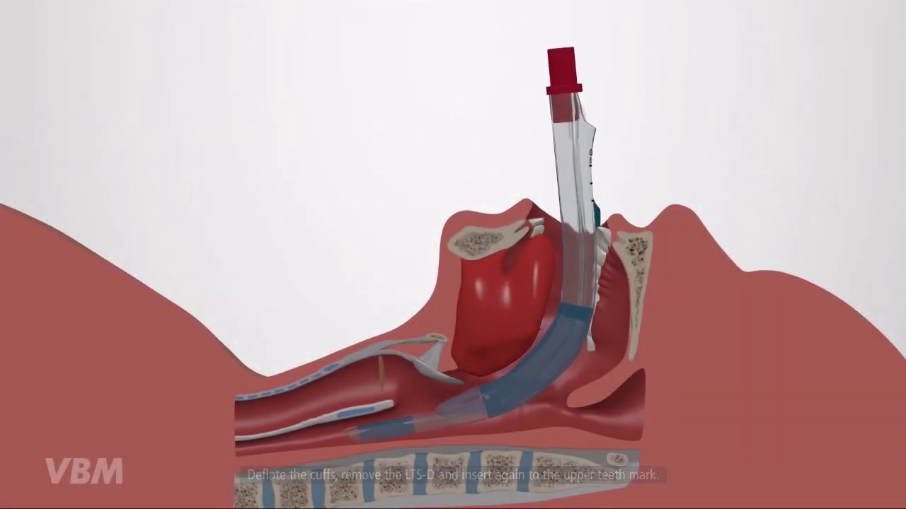 VBM Larynxtube LTS D - YouTube