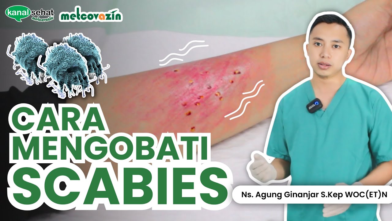 CARA MENGOBATI SCABIES ATAU KUDIS | KANAL SEHAT METCOVAZIN - YouTube