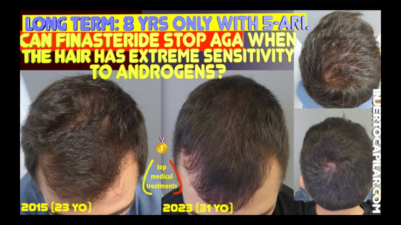 Long term: 8 yrs. Can finasteride stop AGA when the hair has extreme ...