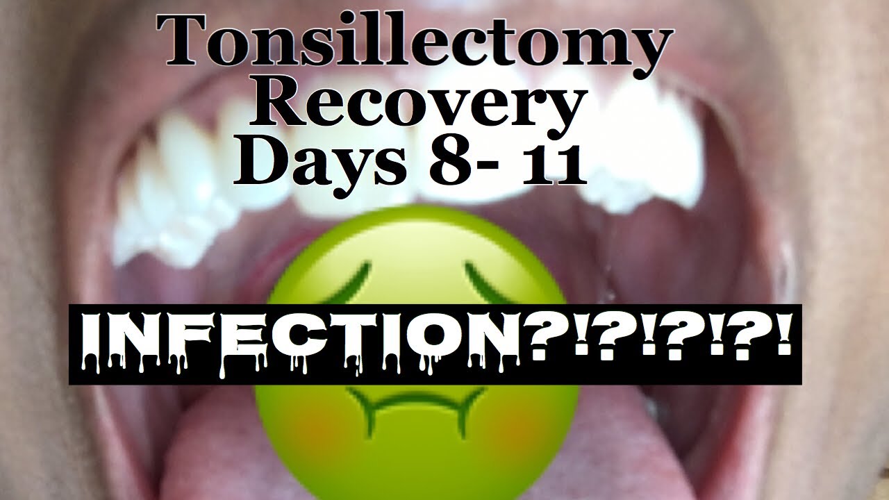 Tonsillectomy Recovery Part 4 - YouTube