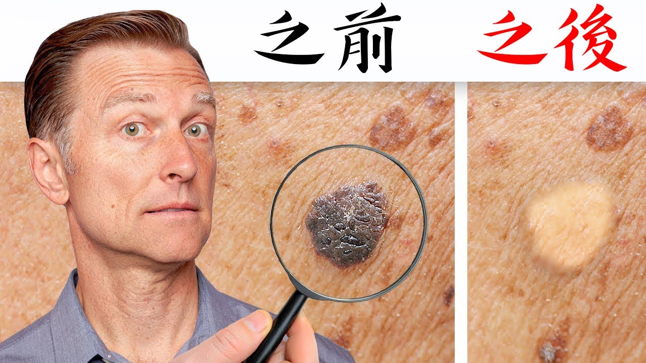 【皮膚】一天快速消除瘜肉和肉疣自然療法,柏格醫生 Dr Berg - YouTube