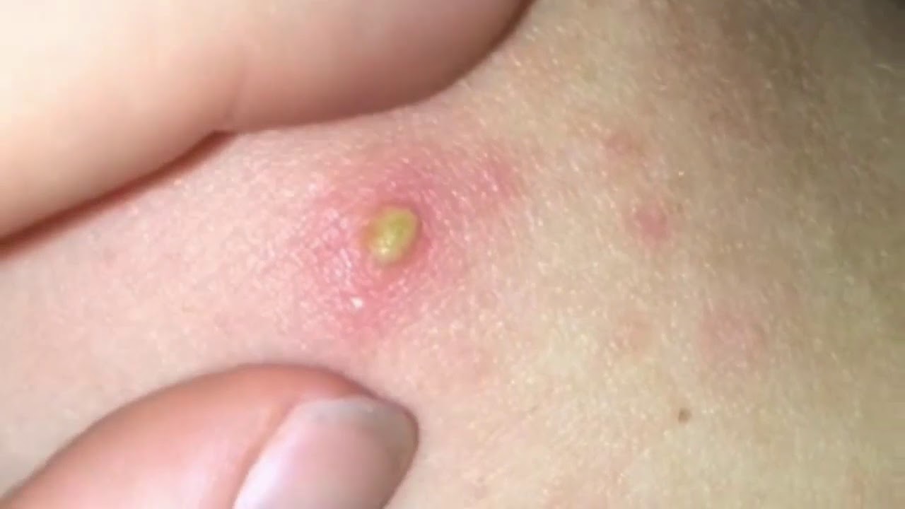 Why Do We Love Pimple Popping, 2020 - YouTube