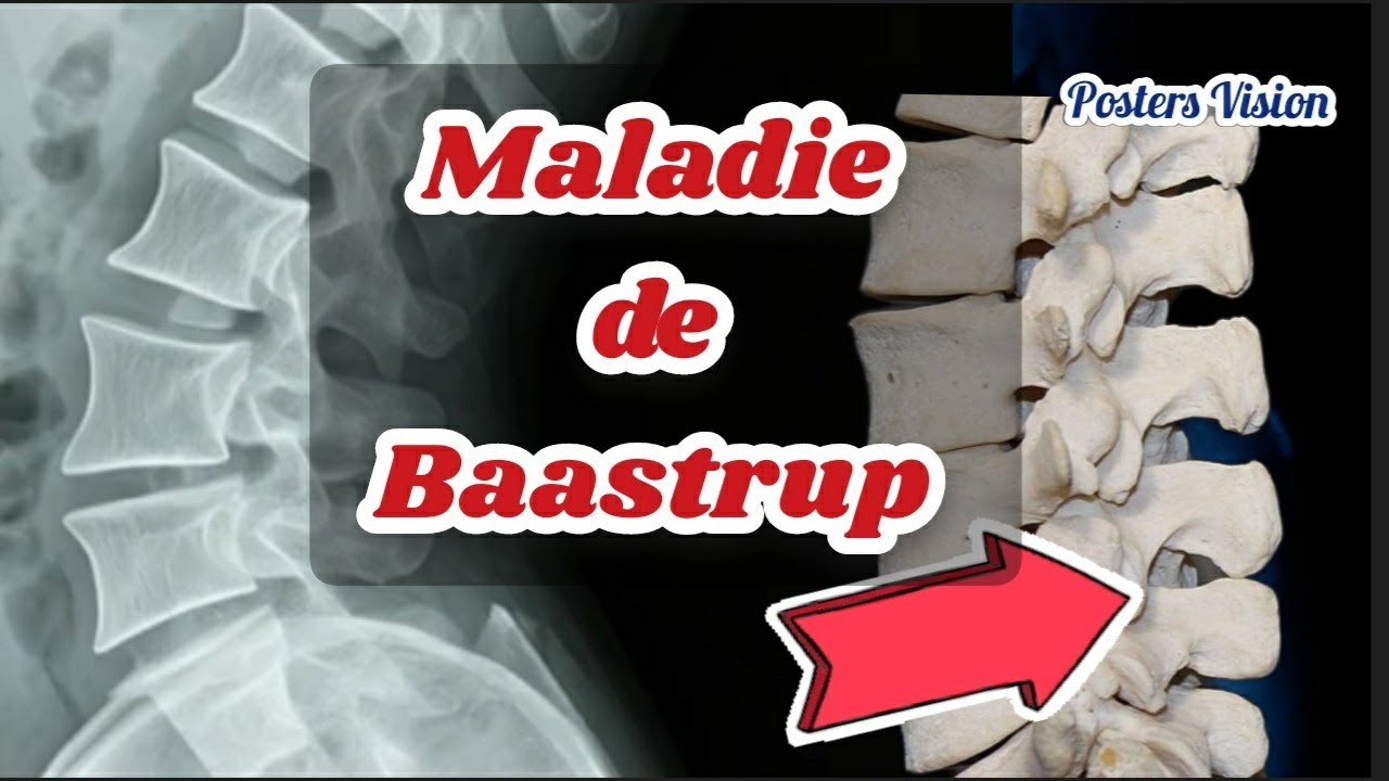 Maladie de Baastrup Arthrose interepineuses vertébrale arthropathie ...