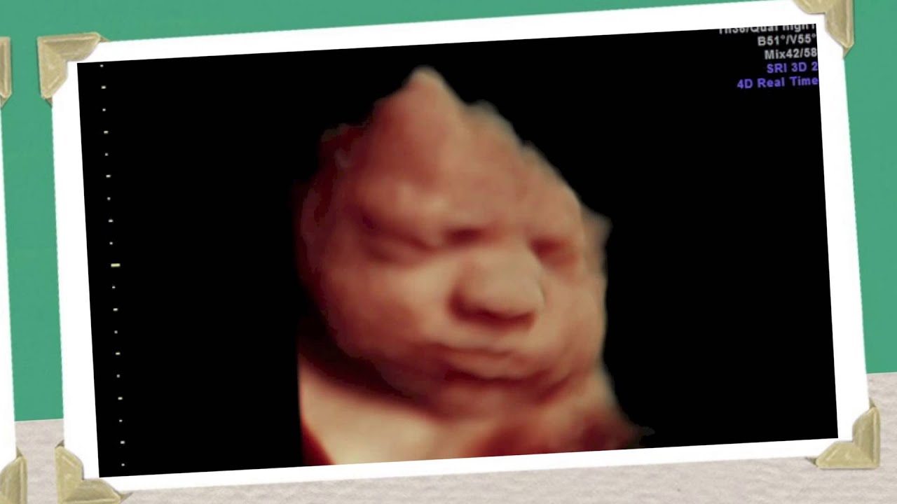 Ecografia 3D/4D - YouTube
