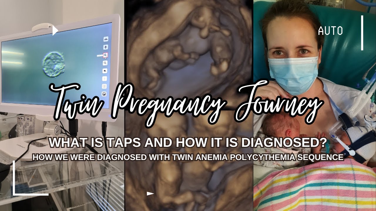 WHAT IS TAPS AND HOW IS IT DIAGNOSED? | Twin Pregnancy Journey | Twin ...