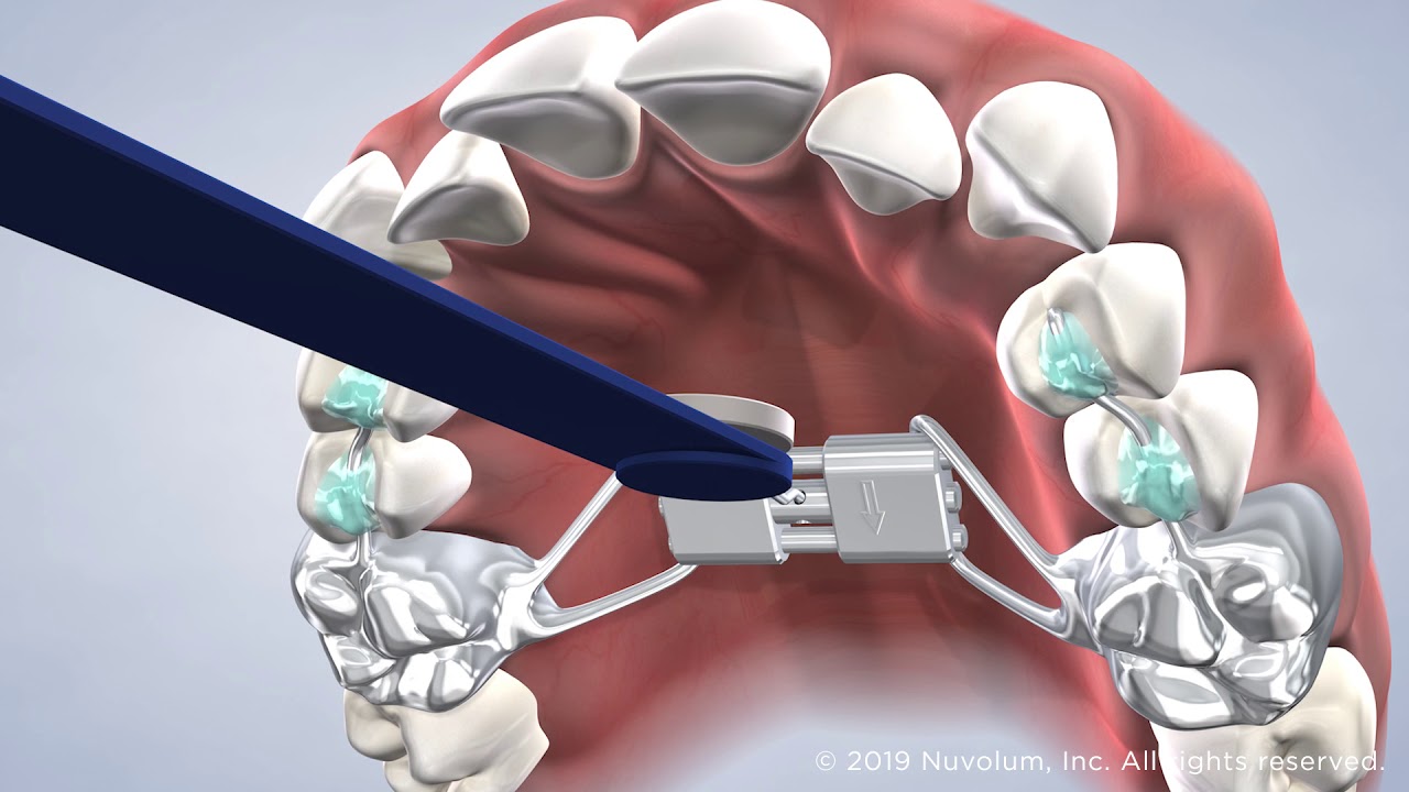 Palatal Expansion at Warren Orthodontics, Springville, UT - YouTube