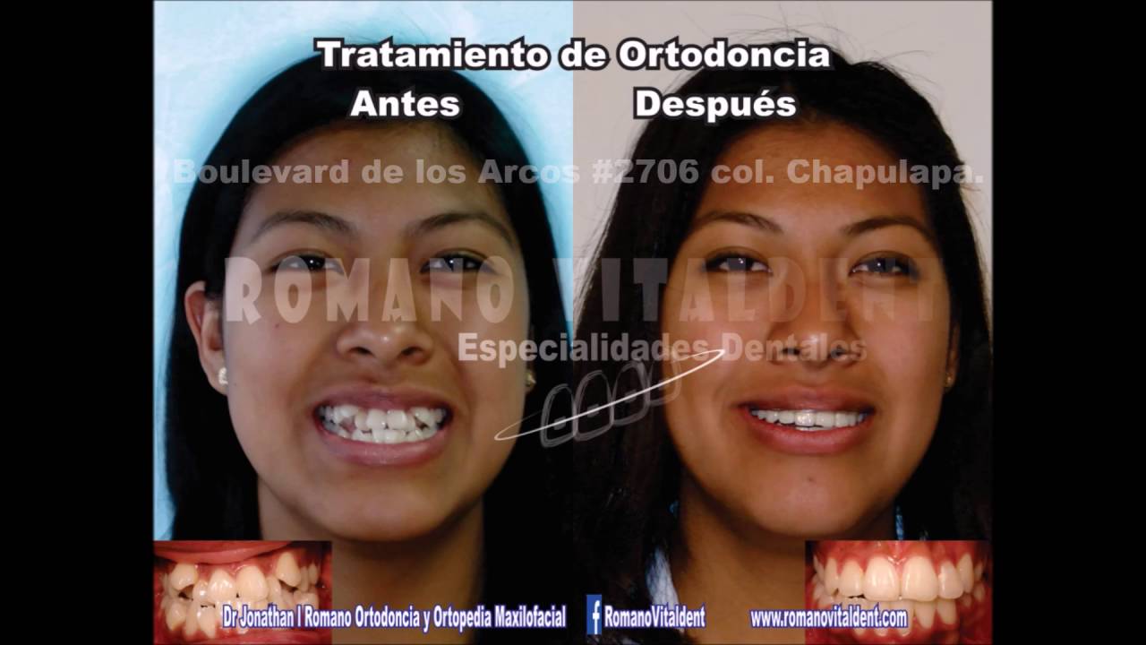 Maloclusion clase III de angle con excelentes resultados obtenidos con ...