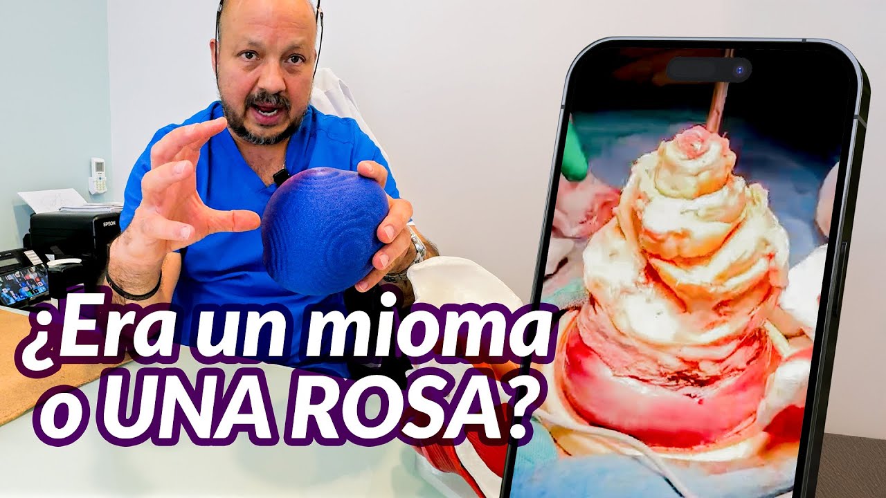 ¿Era un mioma o una rosa? (Mioma intramural de 12 cm y submucoso de 5 ...