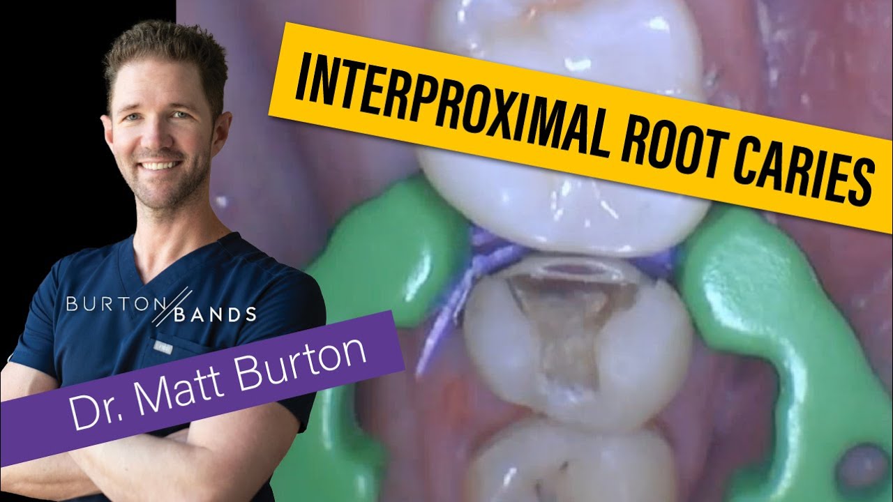 Dr. Matt Burton: When to Use BurtonBands? Interproximal Root Caries ...