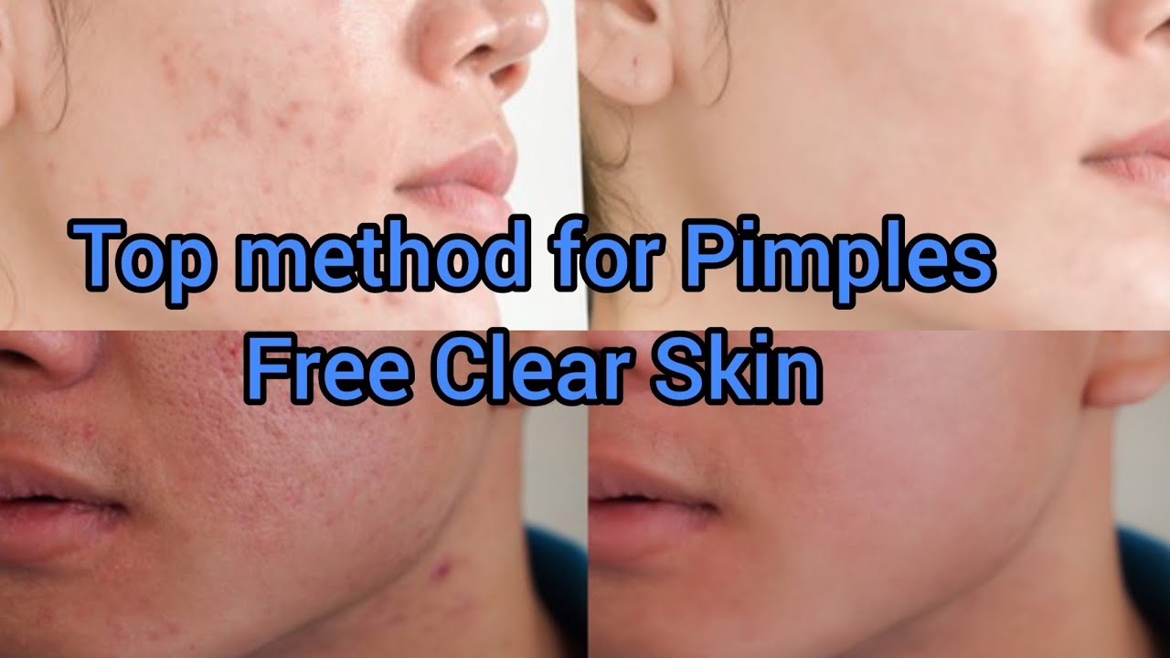 தமிழில்: Super fast pimples free Clear Skin | How to get rid off ...