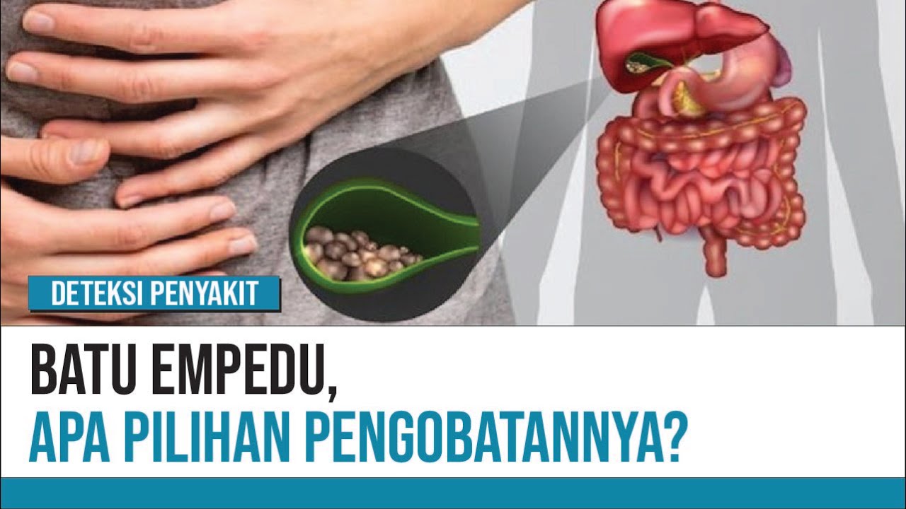 Seperti Apa Pengobatan Untuk Batu Empedu? | Deteksi Penyakit - YouTube