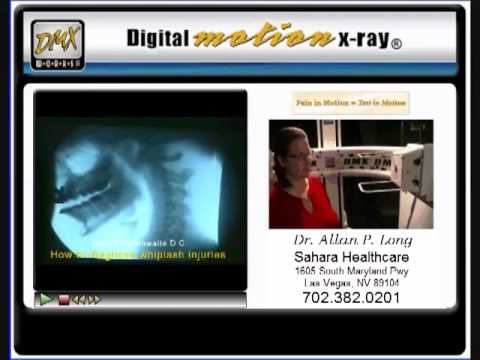 Worst x-rays ever seen - Understanding whiplash - YouTube