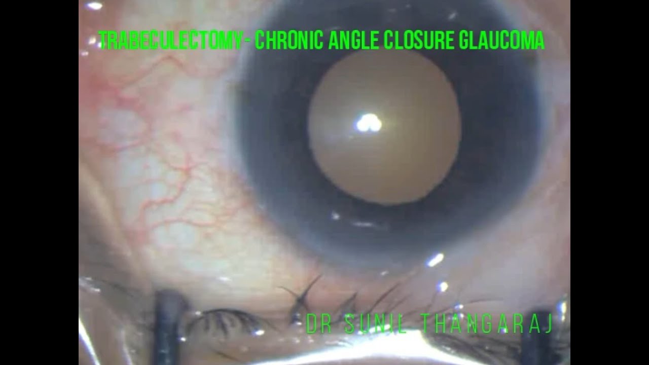 Trabeculectomy in a case of chronic angle closure glaucoma - YouTube