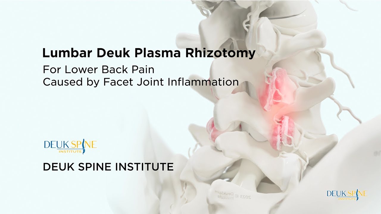 Lumbar Deuk Plasma Rhizotomy (DPR) for Facetogenic Back Pain - (3D ...
