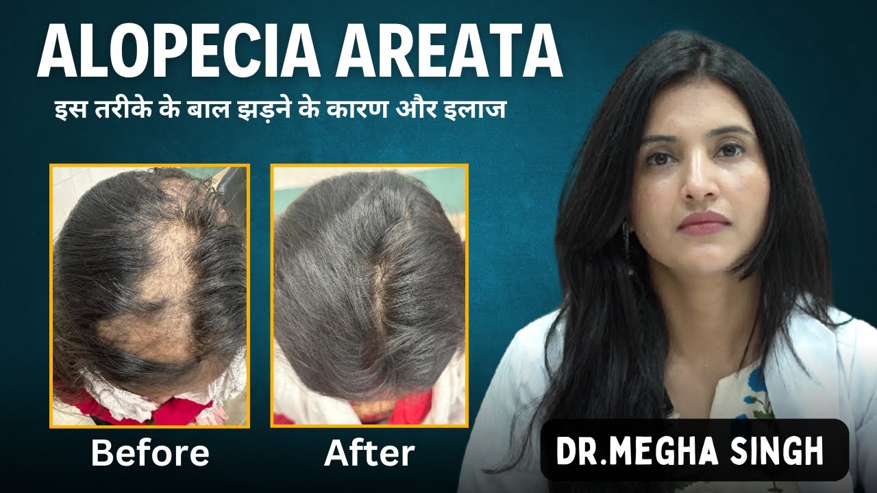 Symptoms and treatment of alopecia areata. PRP, Stem Cell Therapy Dr ...