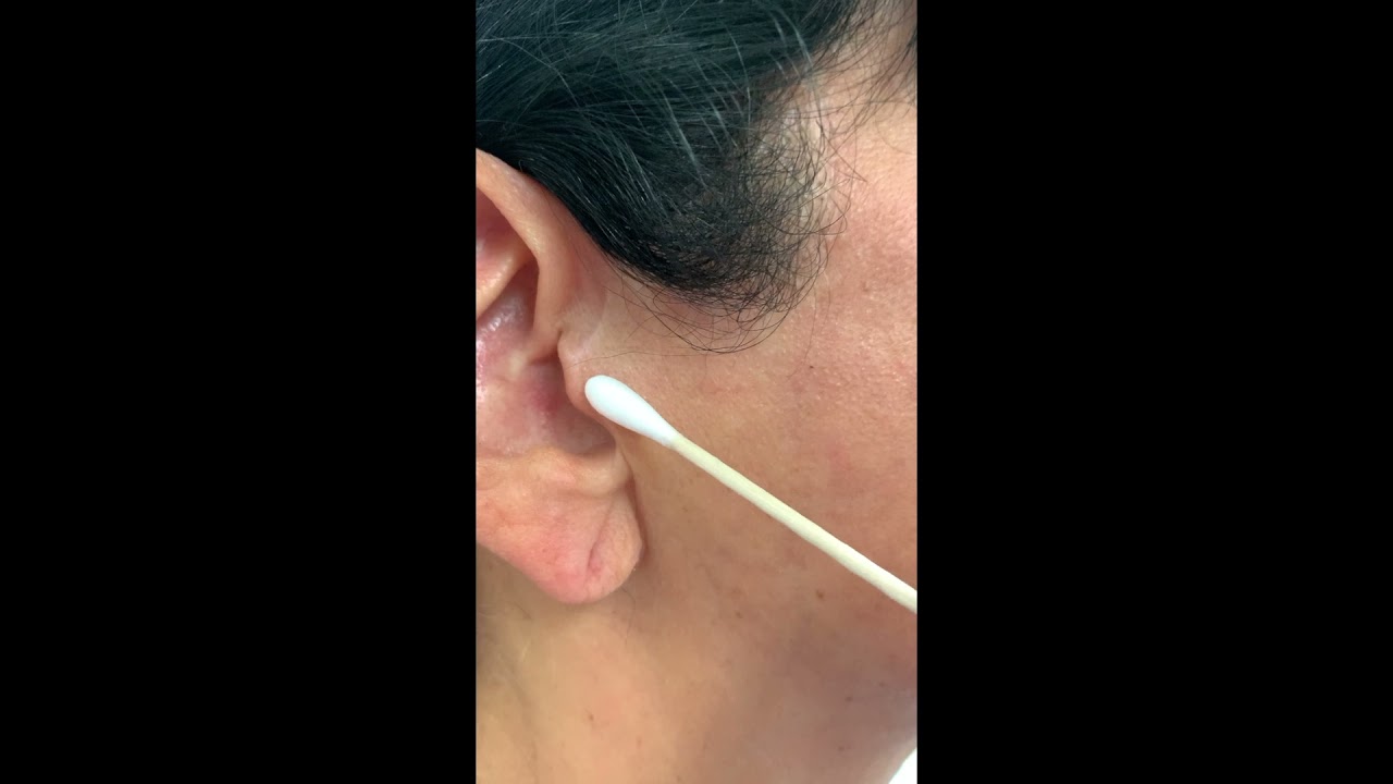 Deep Face Facelift Incision Line - YouTube