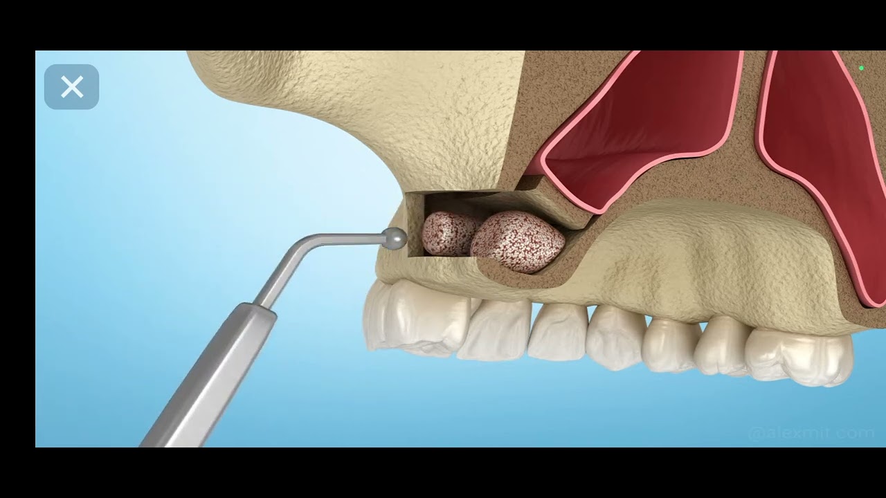 Sinus lifting Oral surgery 3D animation - YouTube