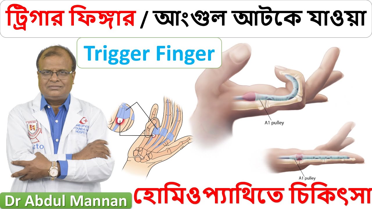 ট্রিগার ফিঙ্গার / আংগুল আটকে যাওয়া / Trigger Finger / Dr Abdul Mannan ...