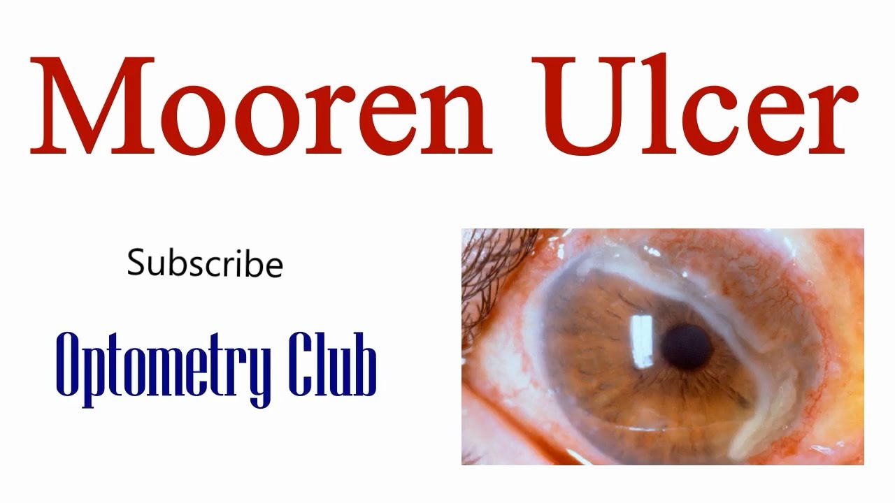 Mooren's Ulcer Introduction, Clinical Features and Treatment - YouTube