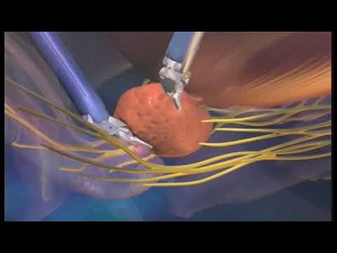 Prostate Removal - YouTube