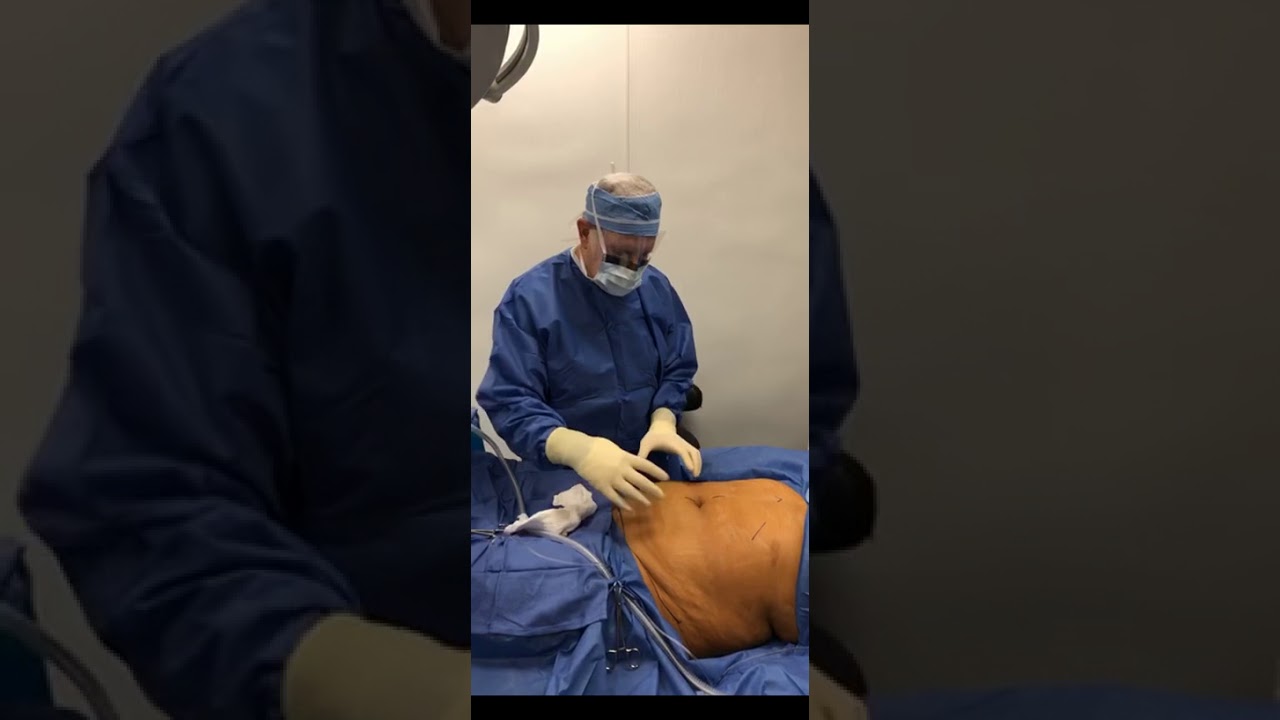 EXTENDED TUMMY TUCK BY DR GABRIEL PATINO 12 20 19 - YouTube