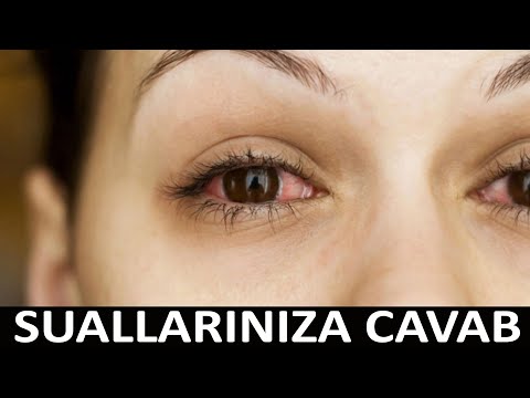 Gözdə qızarma və qaşınmanın MÜALİCƏSİ
