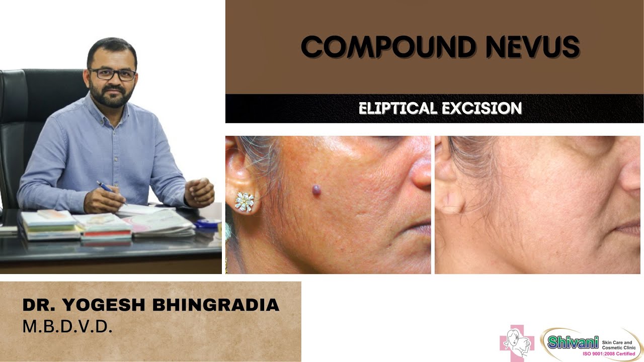 COMPOUND NEVUS | ELIPTICAL EXCISION | SCARLESS MOLE REMOVAL | DR.YOGESH ...