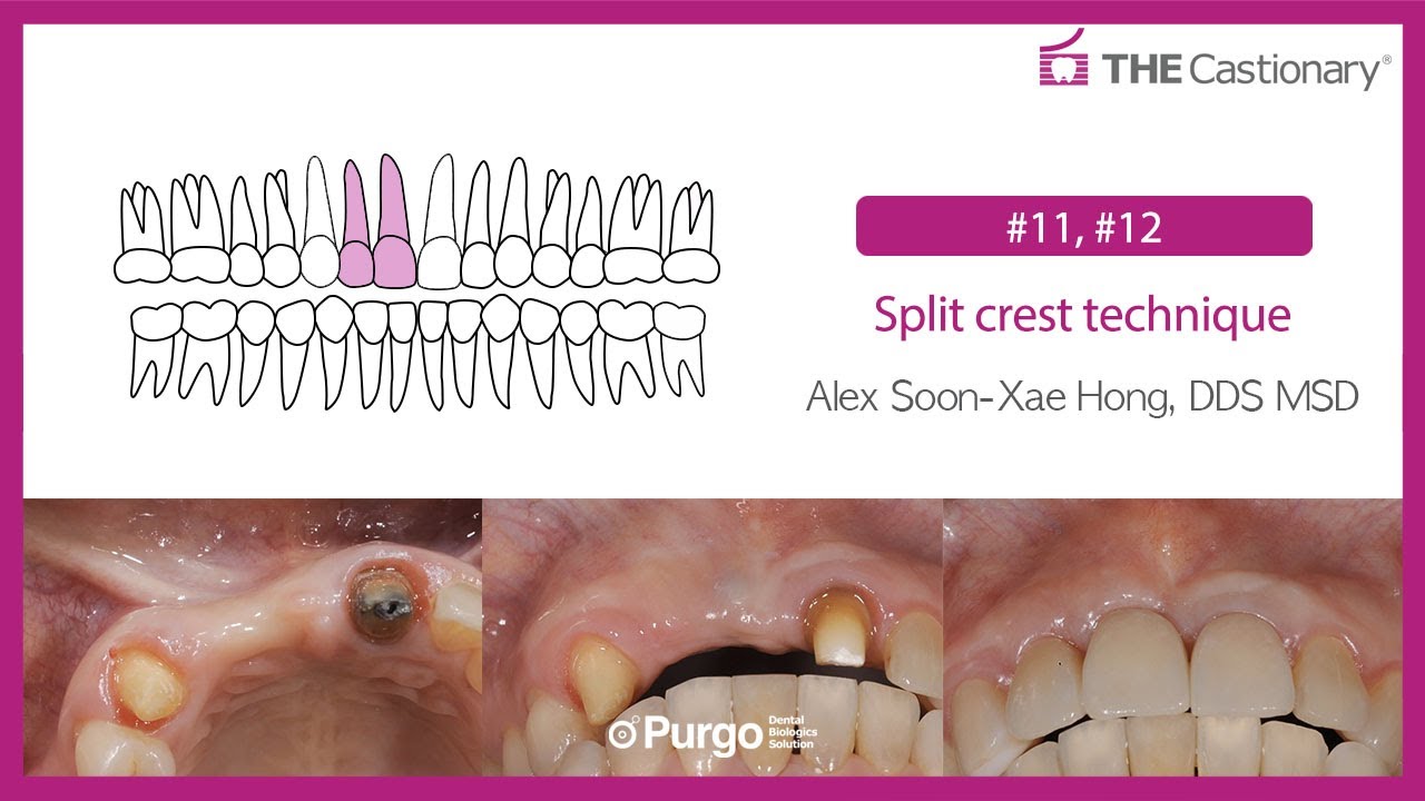 [THE Castionary®] #11, 12 Split crest technique adjacent missing ...