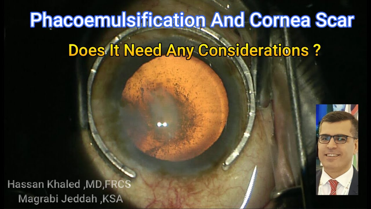 Phacoemulsification And Cornea Scar - YouTube
