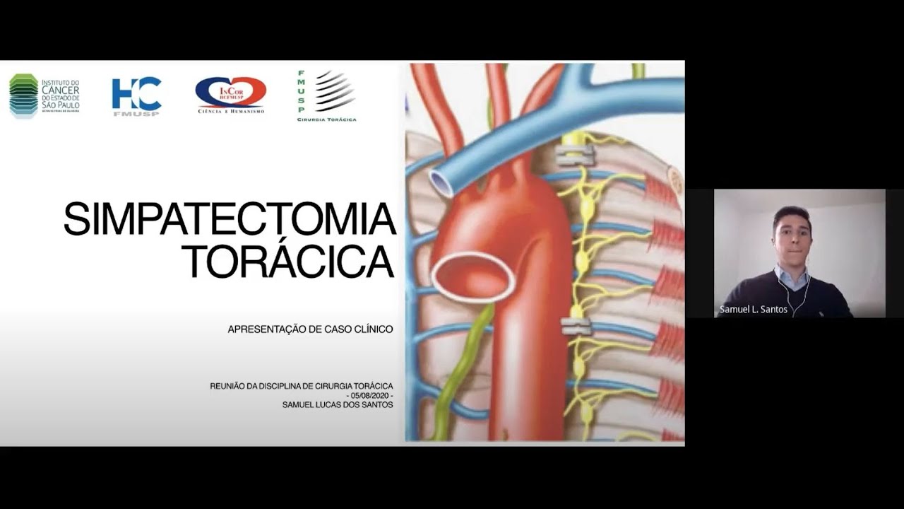 Simpatectomia torácica por arritmia cardíaca refratária - Uma ...