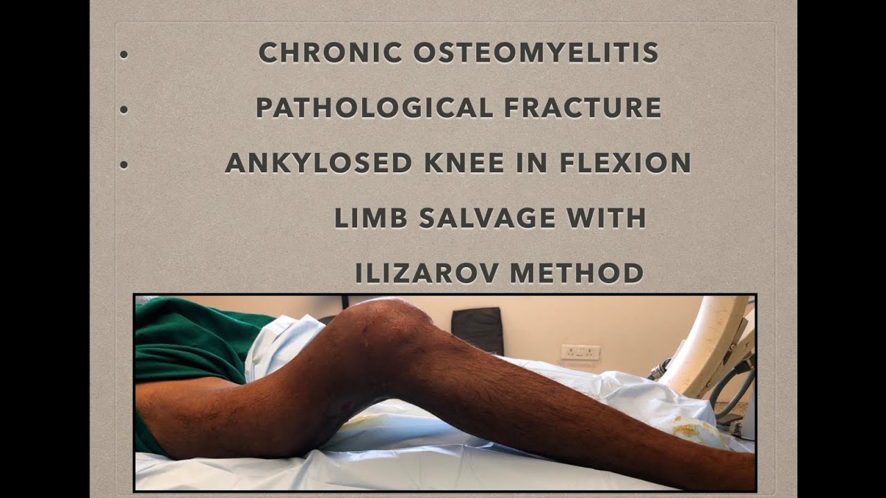 Pathological fracture, chronic osteomyelitis, knee deformity : Limb ...