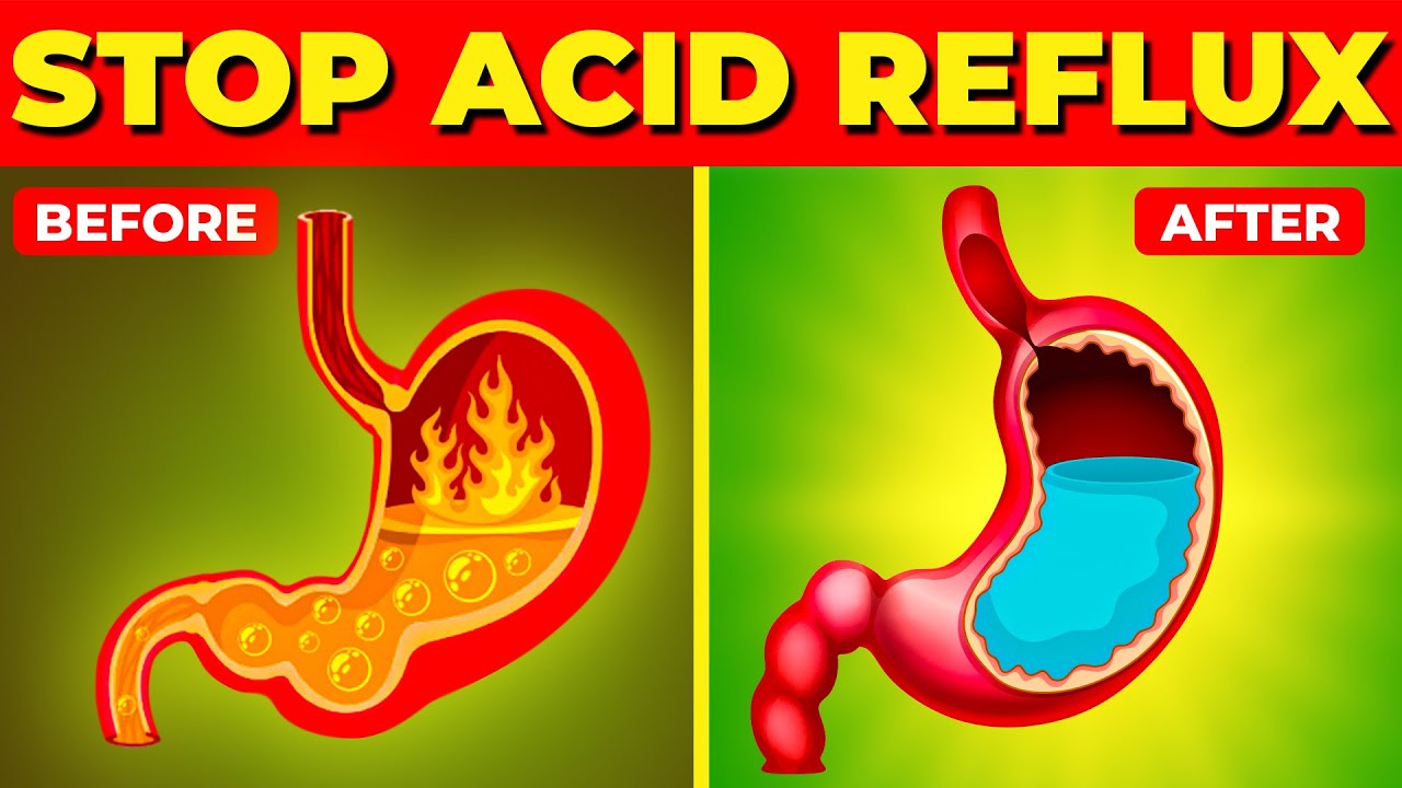 HOW to STOP Acid Reflux Permanently - YouTube
