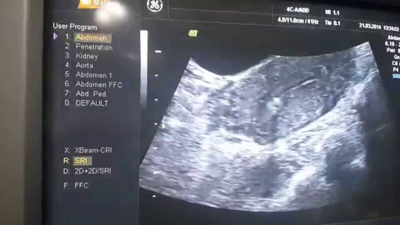 SCI Healthcare Videos:Dummy/ Mock Embryo Transfer - YouTube